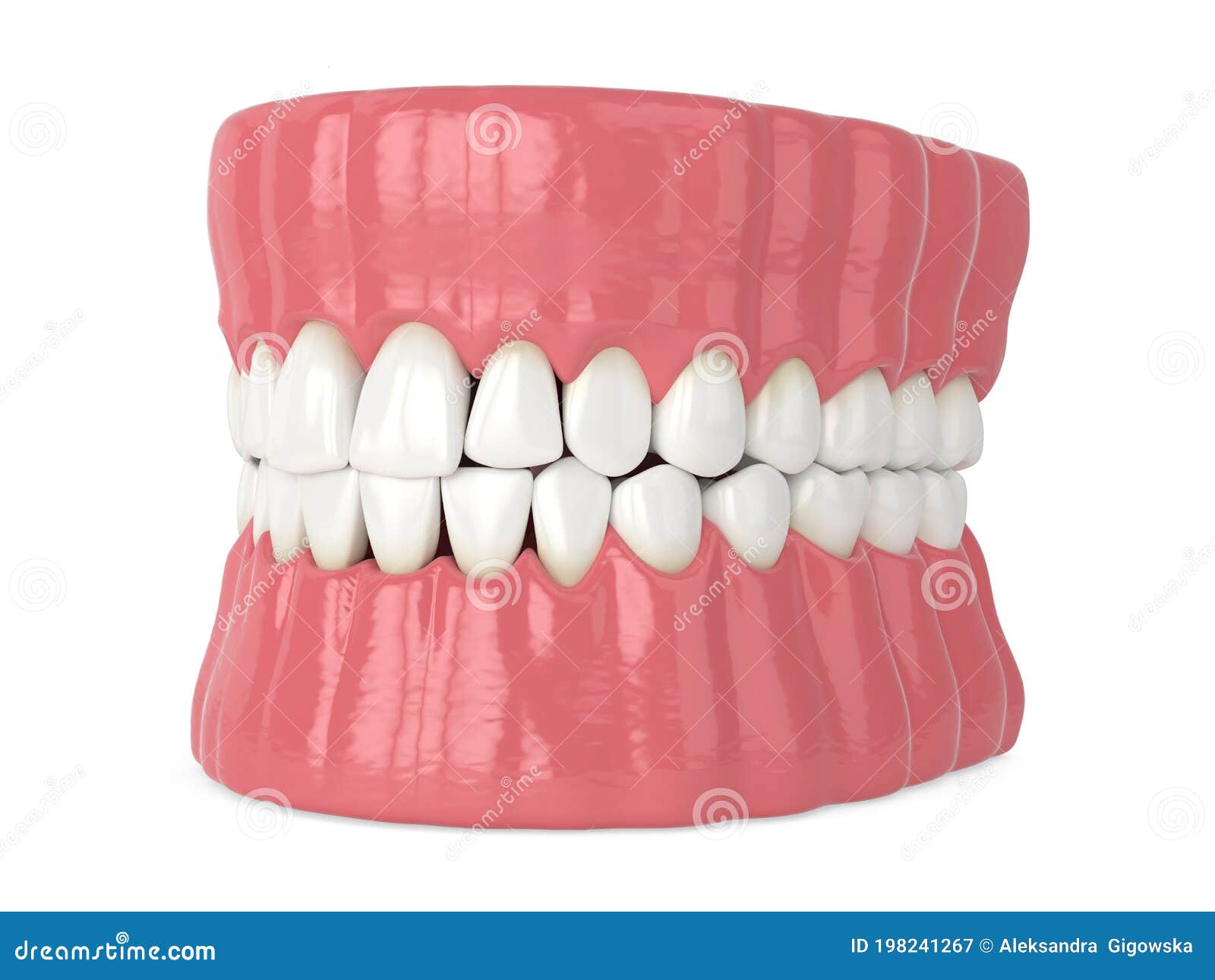 3d Render of Human Jaw with Black Triangles Stock Illustration ...