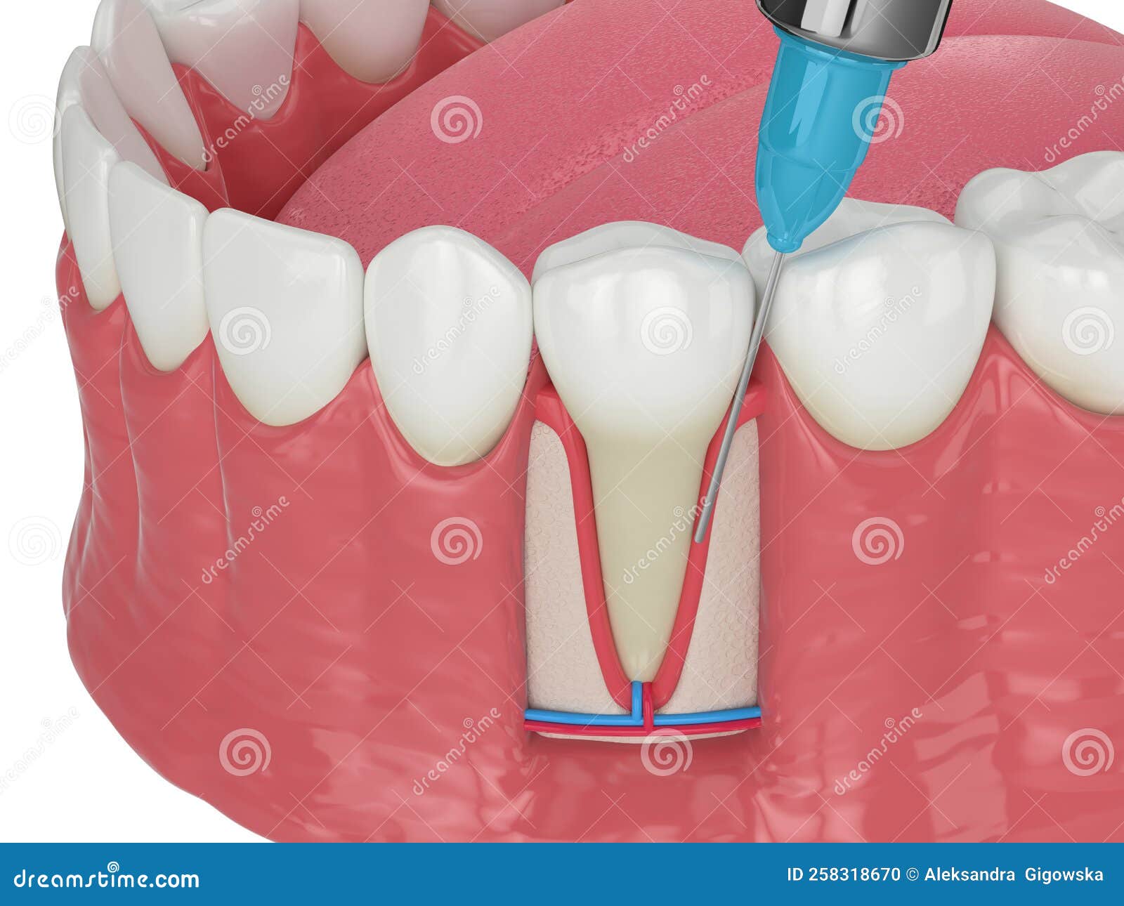 3d Render of Human Jaw with Intraligamentary Anesthesia Procedure Stock ...