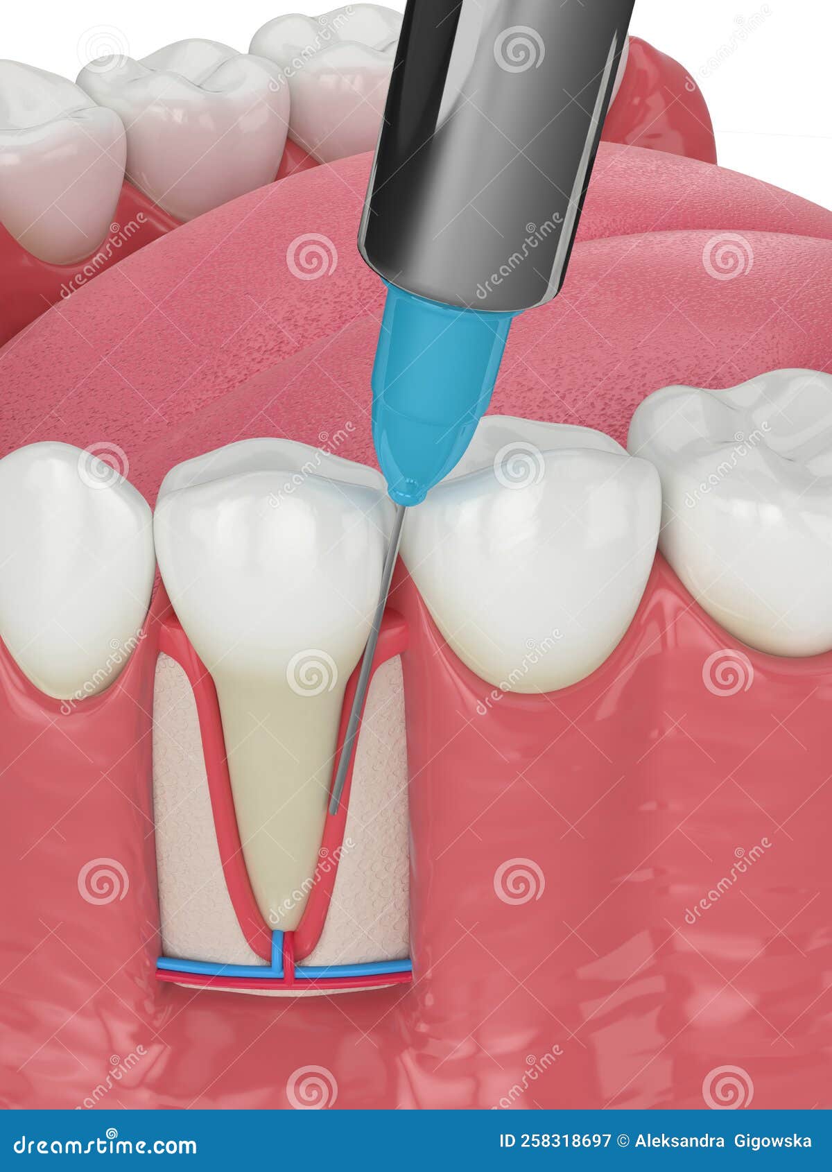 3d Render of Human Jaw with Intraligamentary Anesthesia Procedure Stock ...