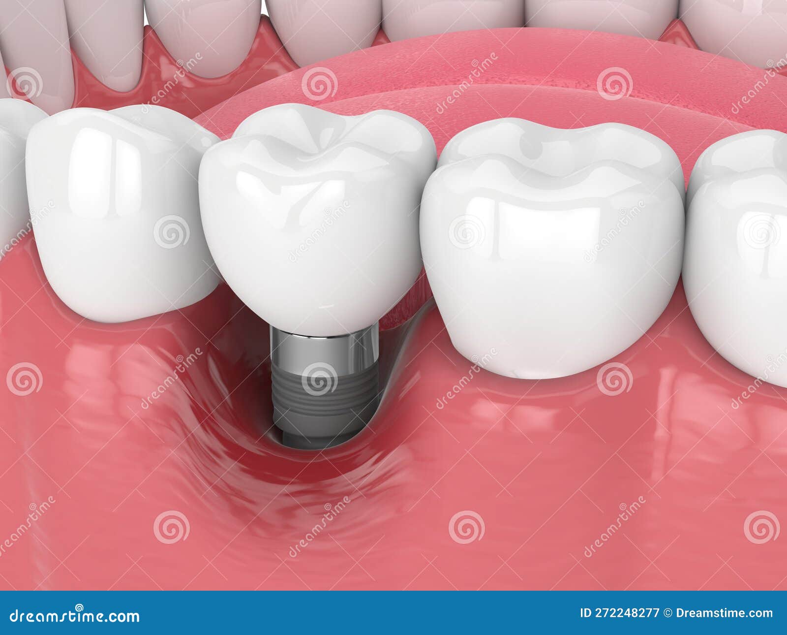 3d Render of Human Jaw with Peri Implantitis Disease Stock Illustration ...