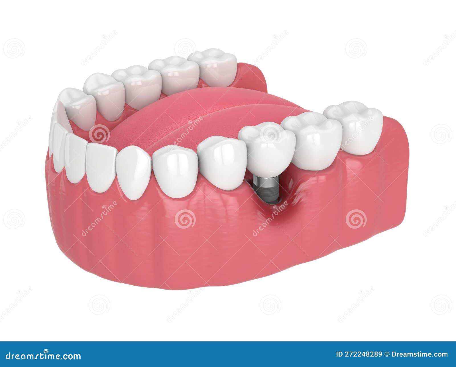 Implantitis Cartoons, Illustrations & Vector Stock Images - 21 Pictures ...