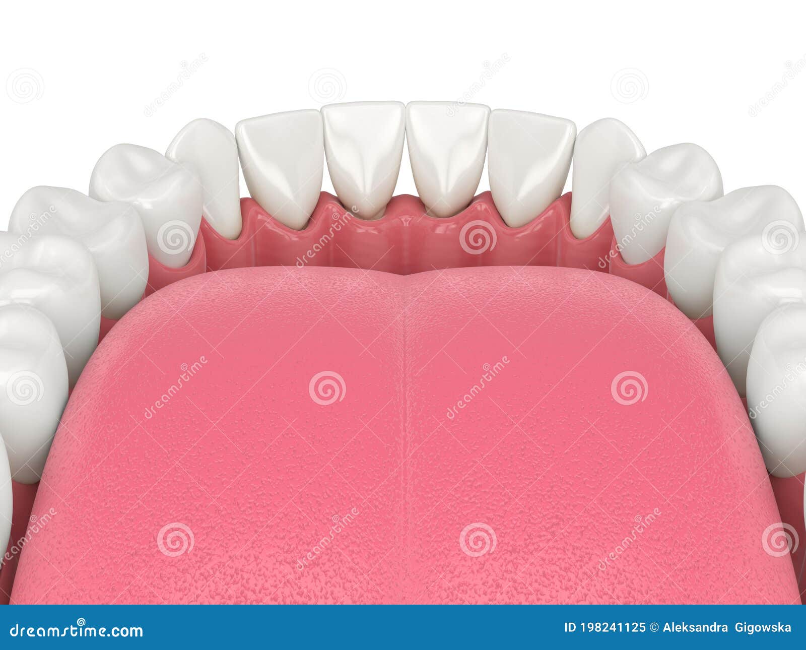 3d Render of Human Lower Jaw with Black Triangles Stock Illustration ...