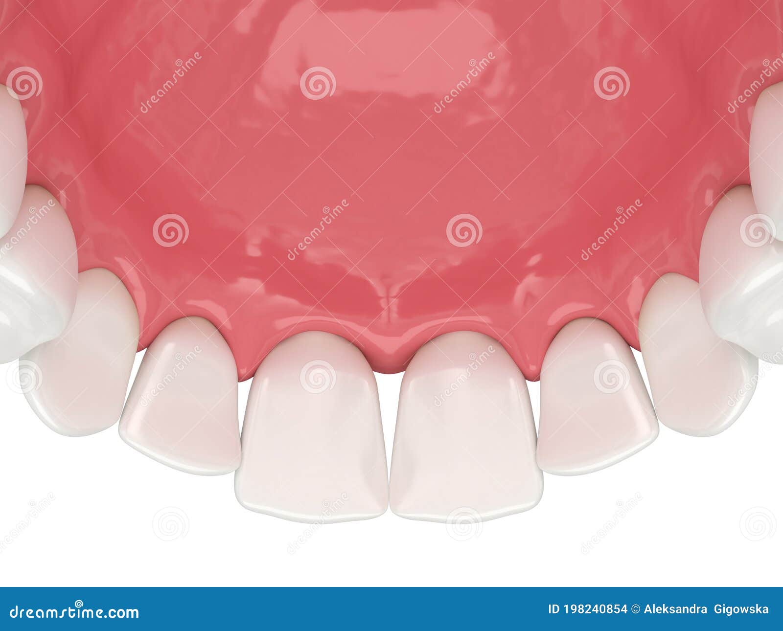 3d Render of Human Upper Jaw with Black Triangles Stock Illustration ...