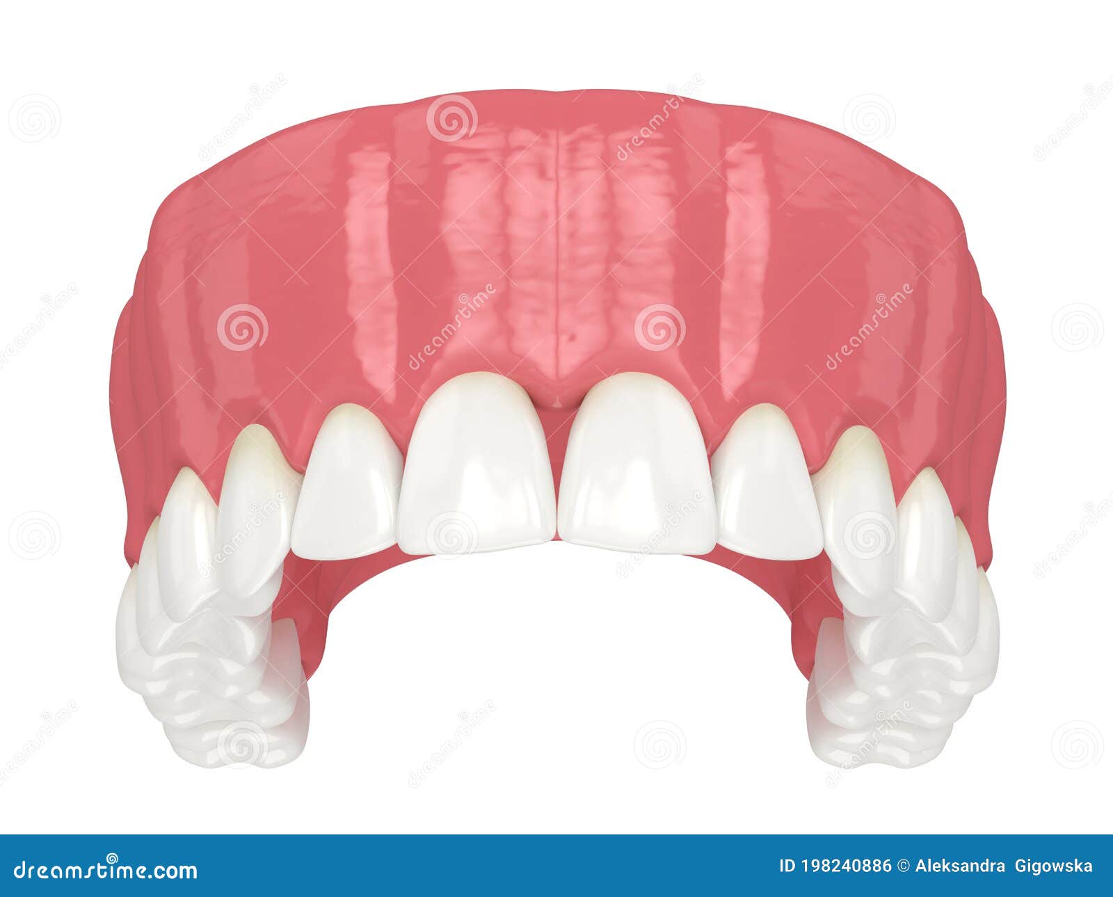 3d Render of Human Upper Jaw with Black Triangles Stock Illustration ...