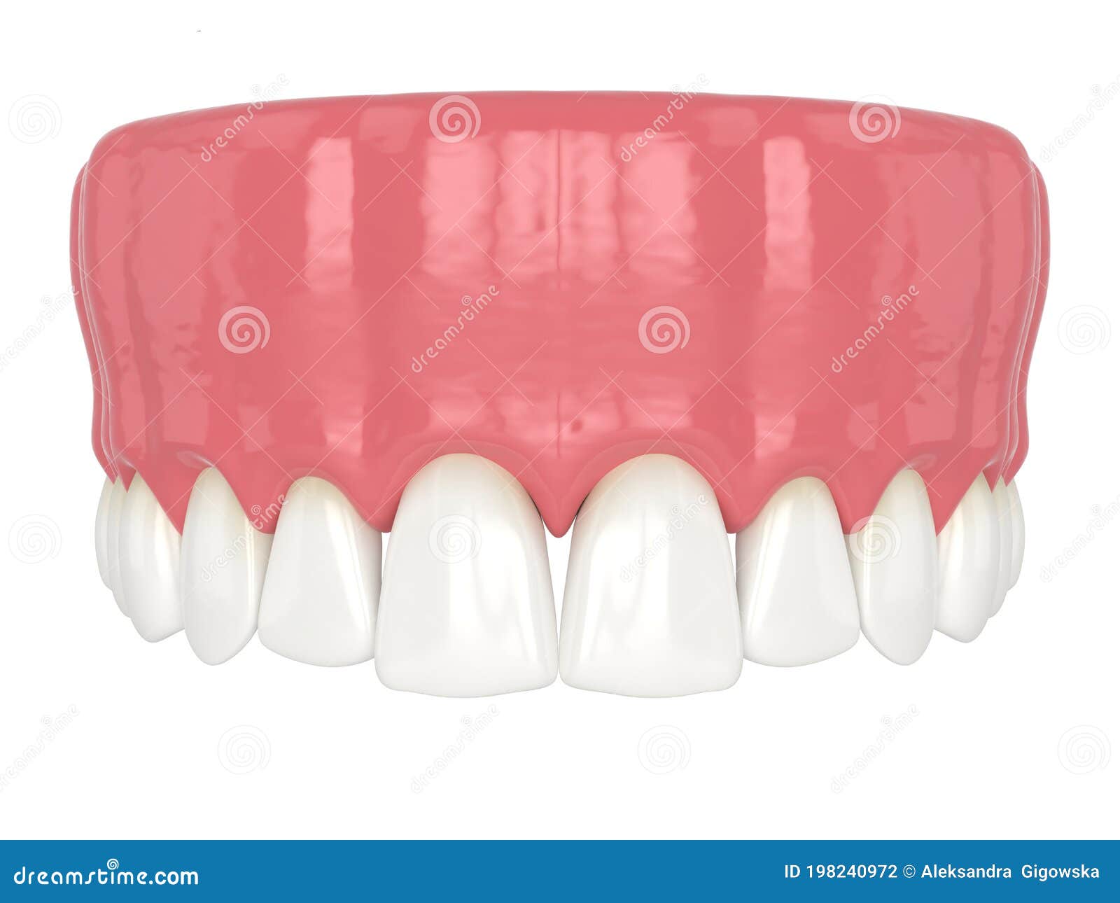 3d Render Of Upper Jaw With Teeth And Dental Incisor Crown Stock ...