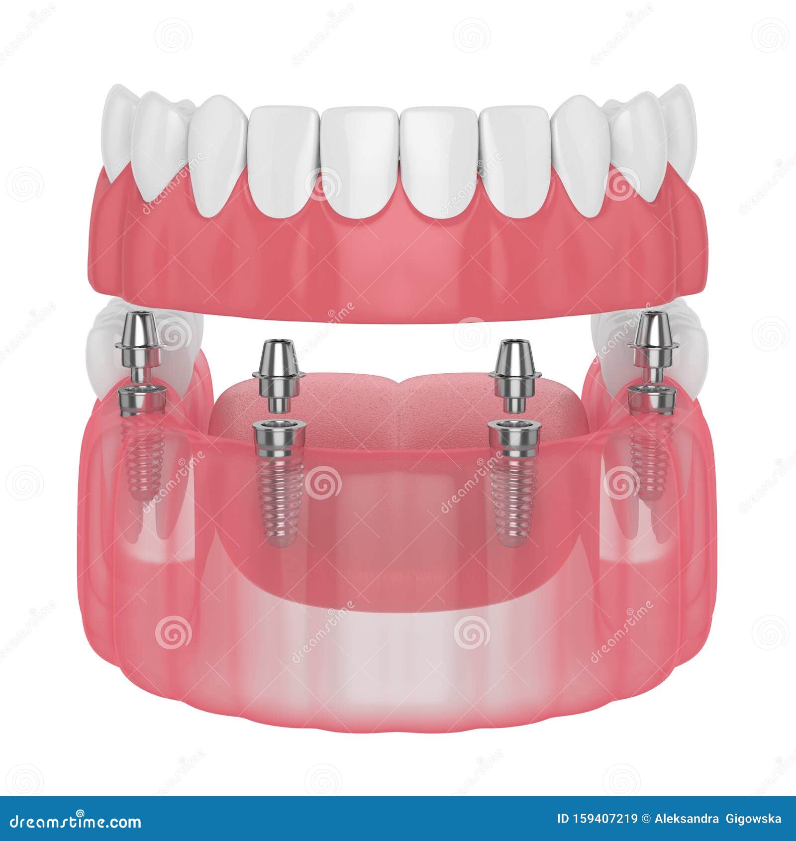 3d Render of Implant Partial Denture Stock Illustration - Illustration ...