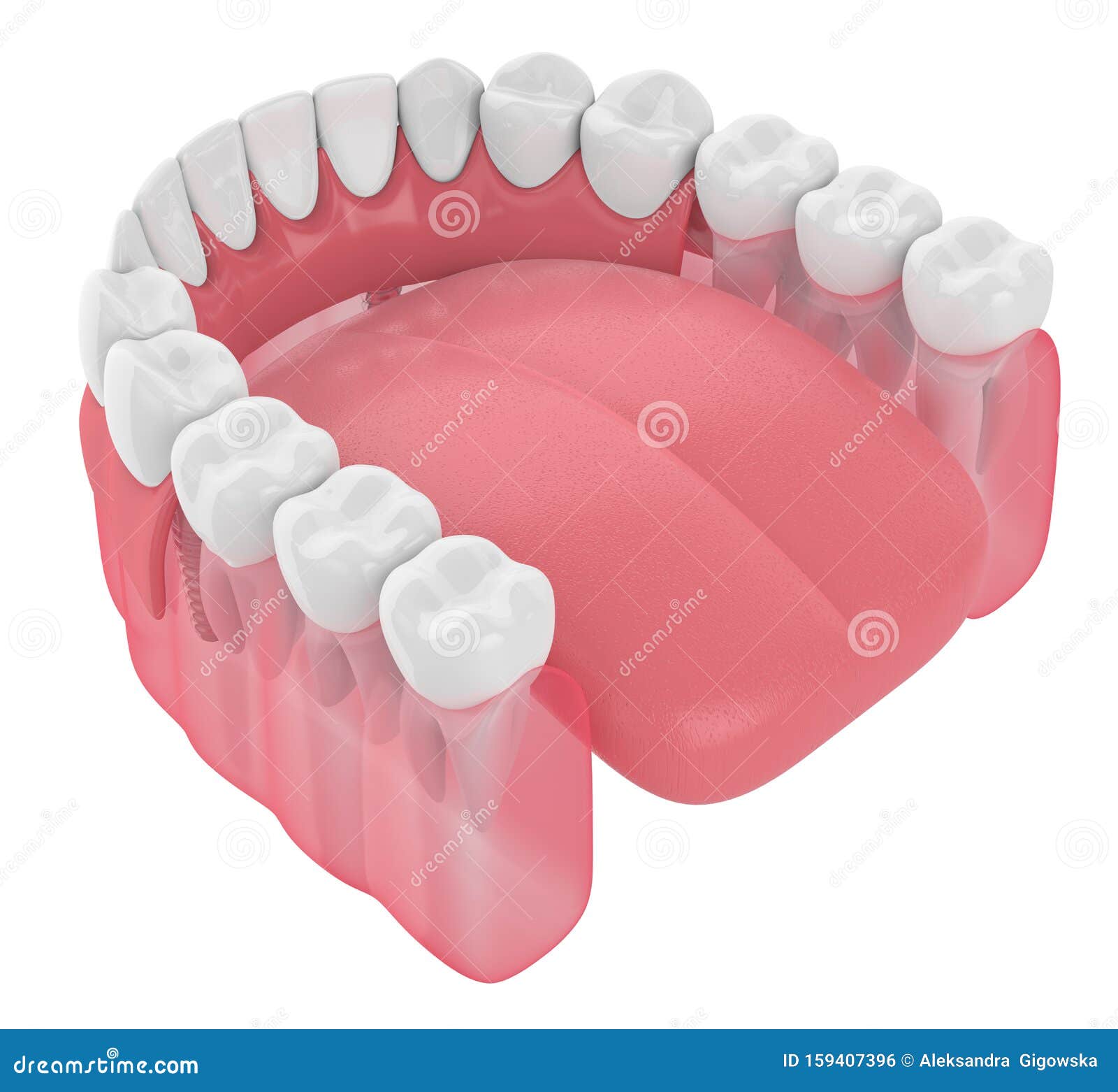 3d Render Of Jaw With Implant Screw And Buried Healing Cap Under Gums ...
