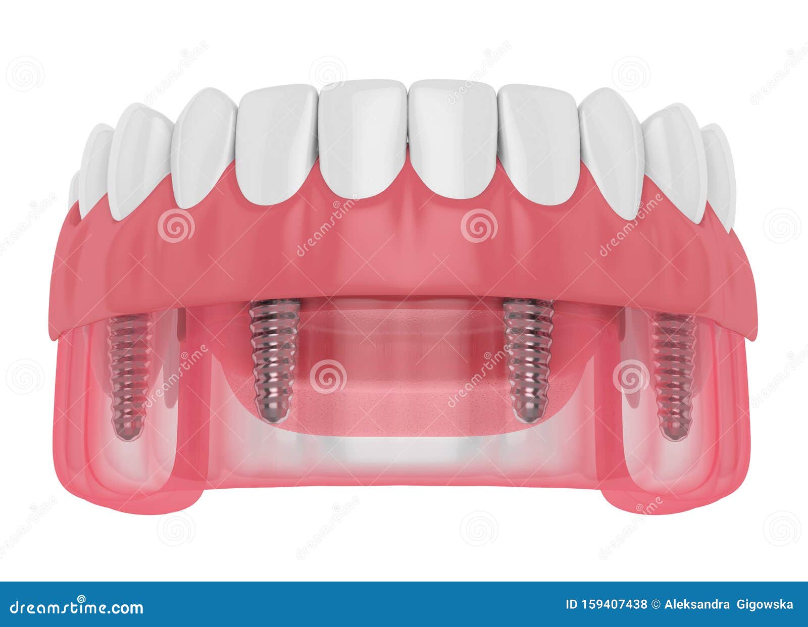 3d Render Of Jaw With Implant Screw And Buried Healing Cap Under Gums ...