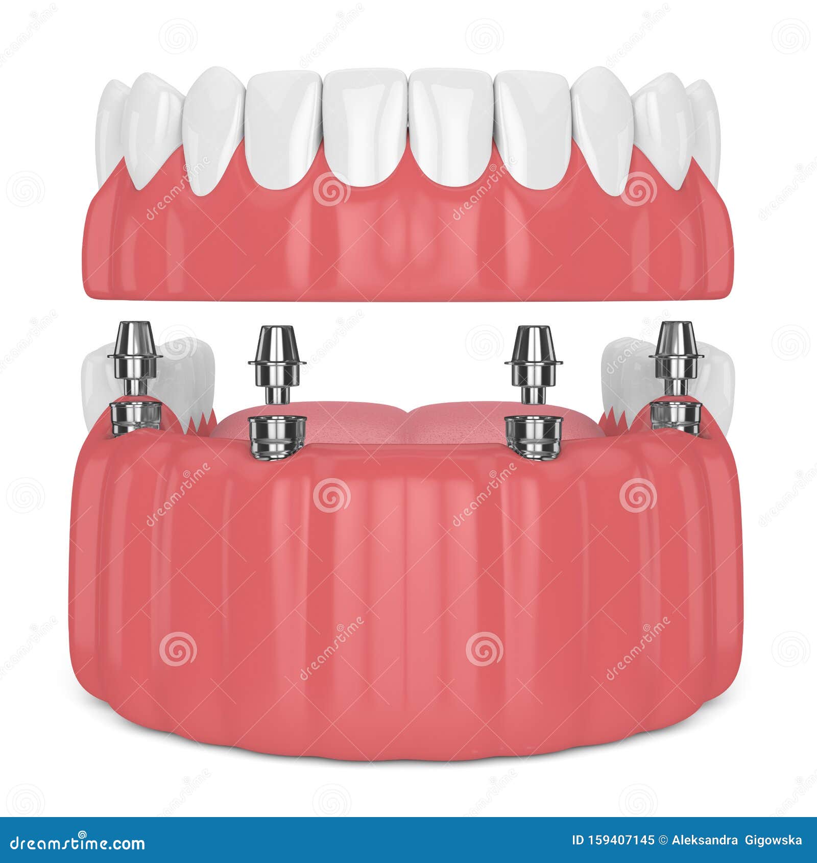 3d Render Of Jaw With Implant Screw And Buried Healing Cap Under Gums ...