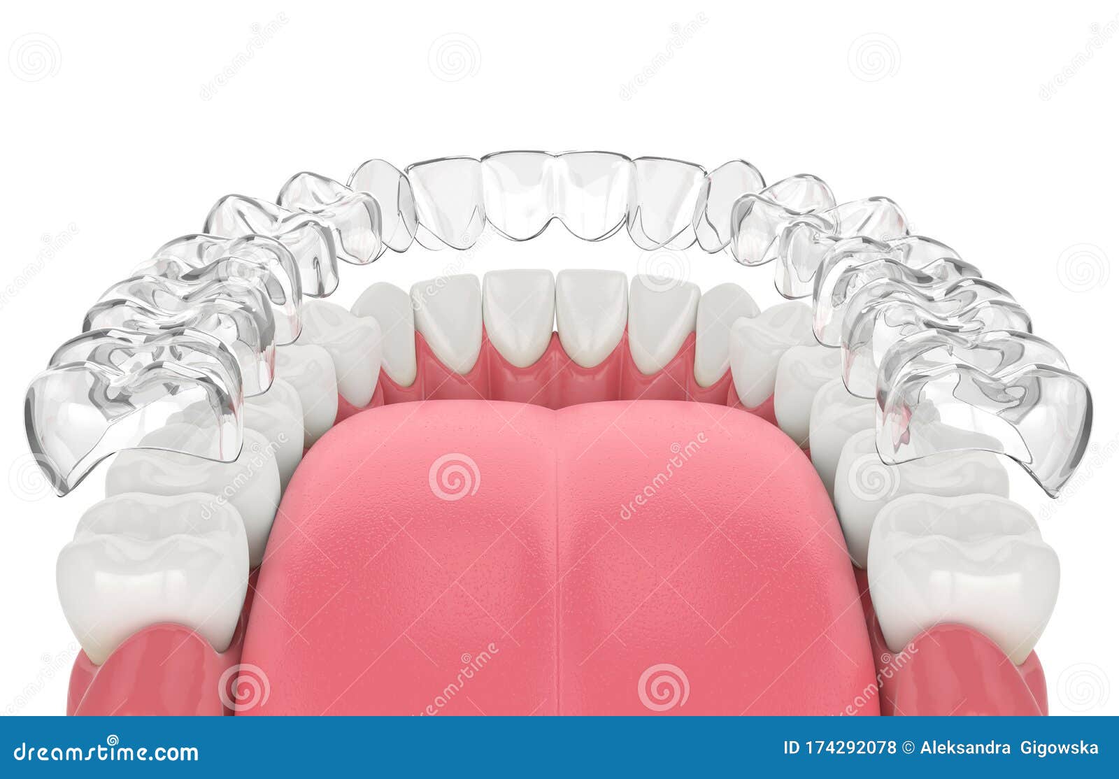 3d Render of Invisalign Removable Retainer with Lower Jaw Stock ...