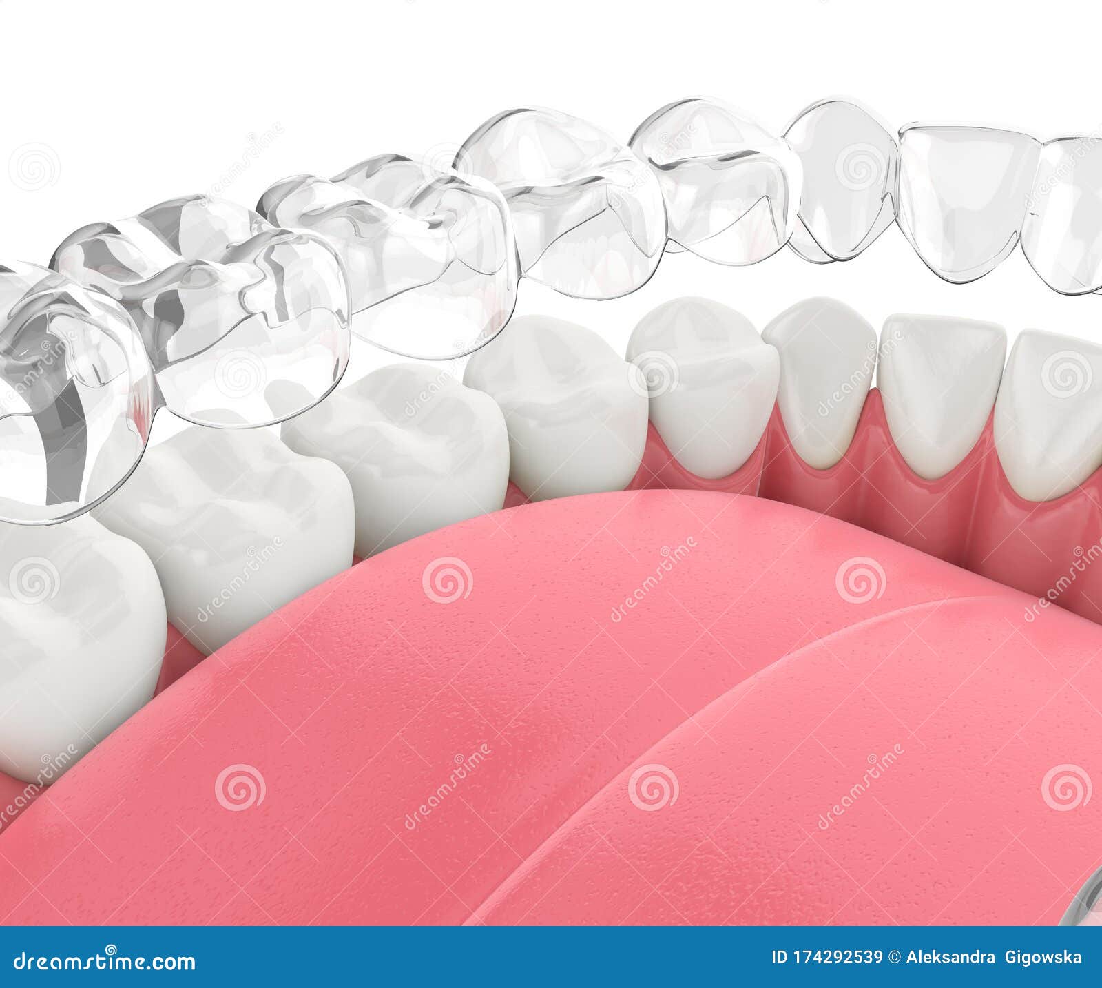 3d Render of Invisalign Removable Retainer with Lower Jaw Stock ...