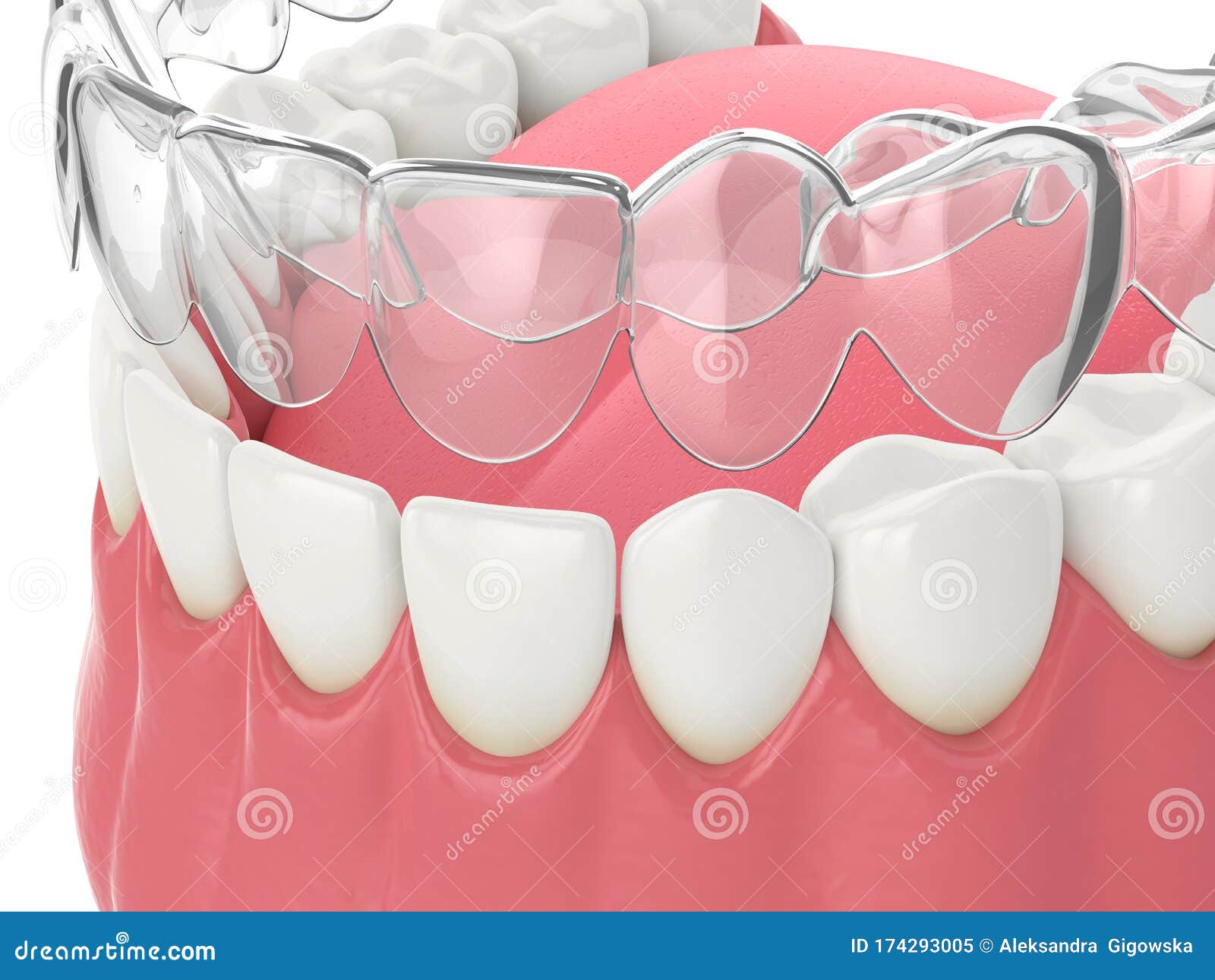 3d Render Of Removable Full Implant Denture Royalty-Free Stock ...