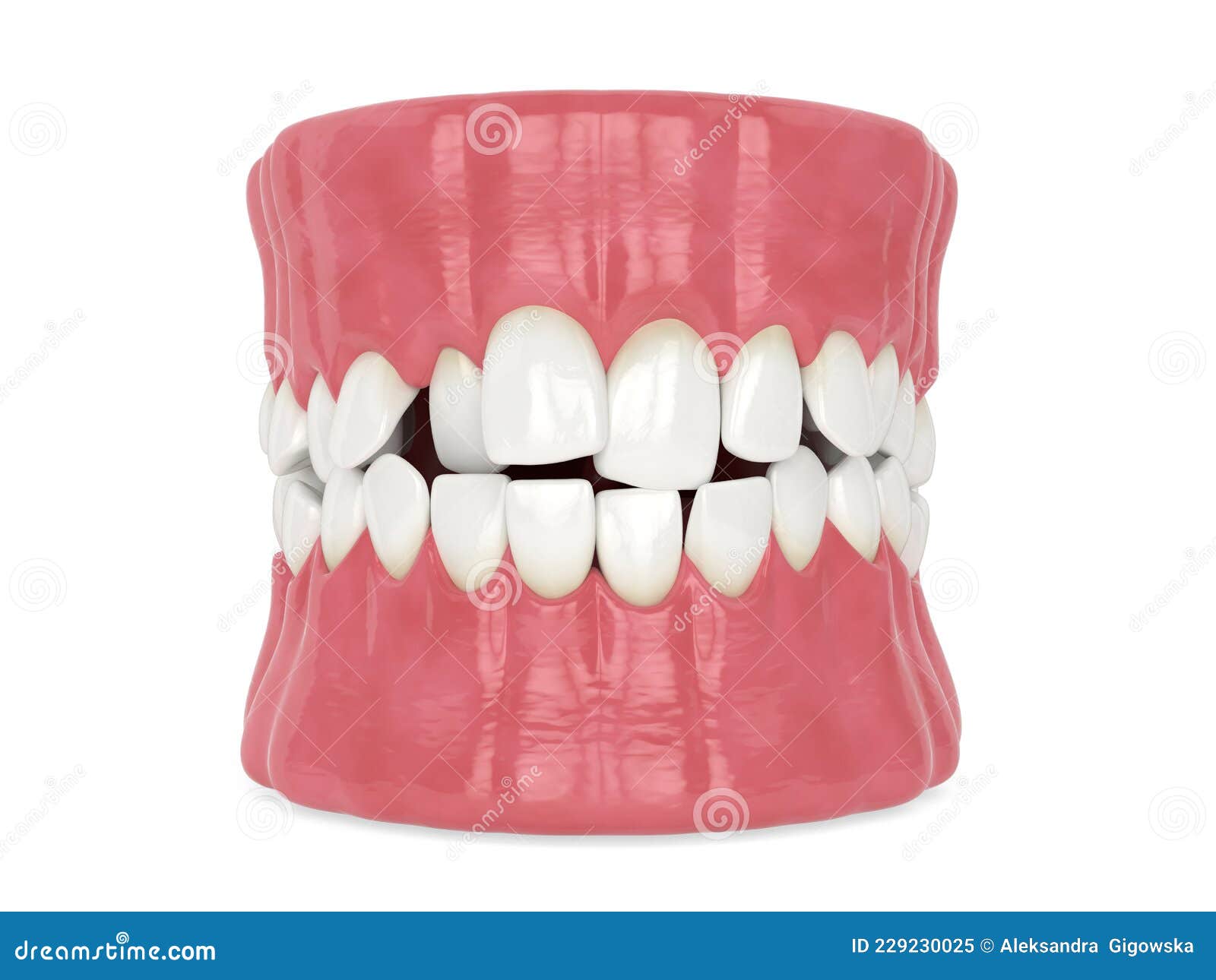 3d Render Of Toothing With Dental Implants Royalty-Free Stock ...