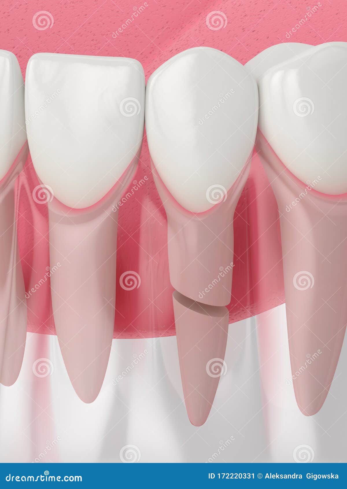 3d Render of Jaw with Cracked Tooth Root Stock Illustration ...