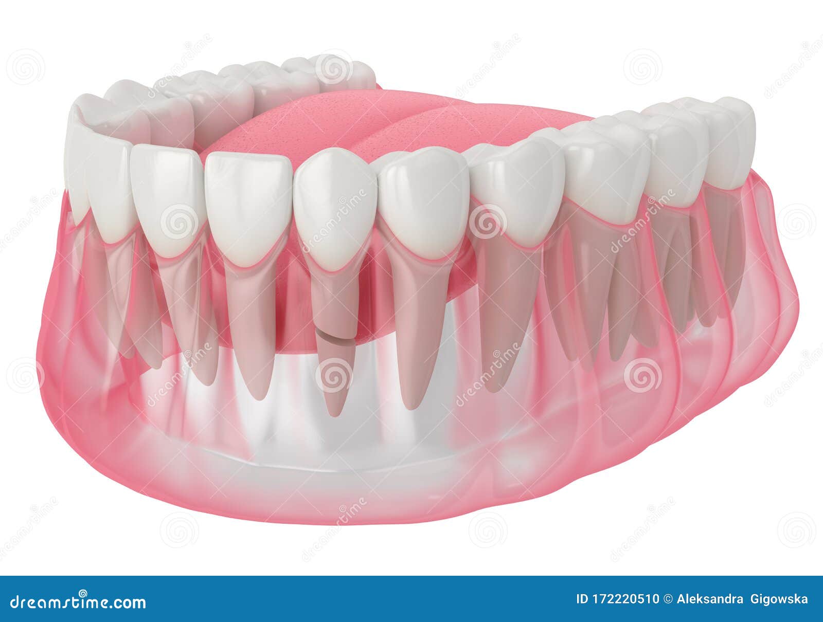 3d Render of Jaw with Cracked Tooth Root Stock Illustration ...