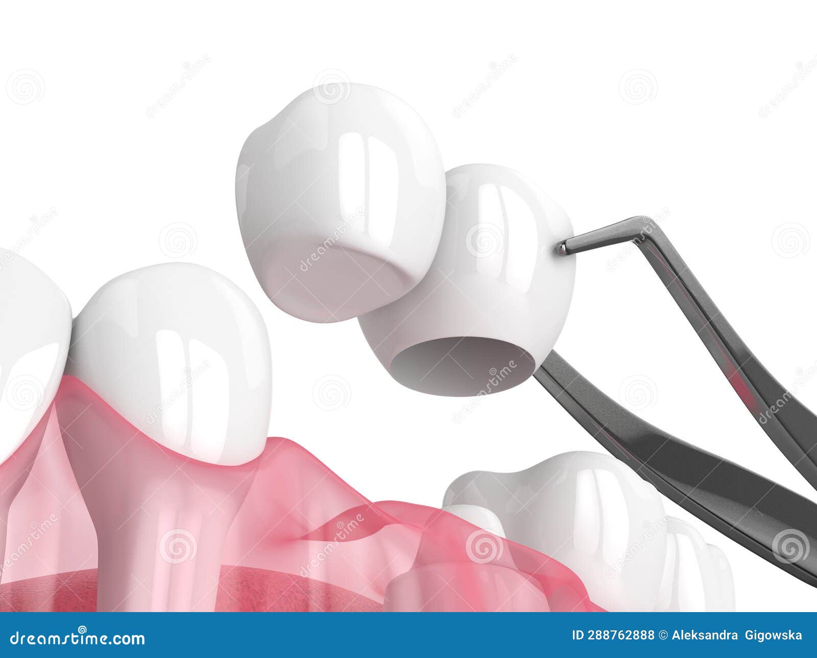 3d Render of Jaw with Dental Cantilever Bridge on Embedded Tooth Stock ...