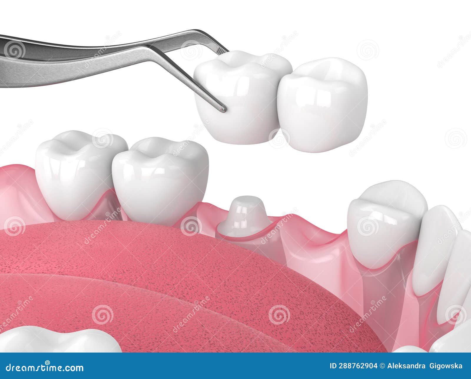 3d Render of Jaw with Dental Cantilever Bridge on Embedded Tooth Stock ...