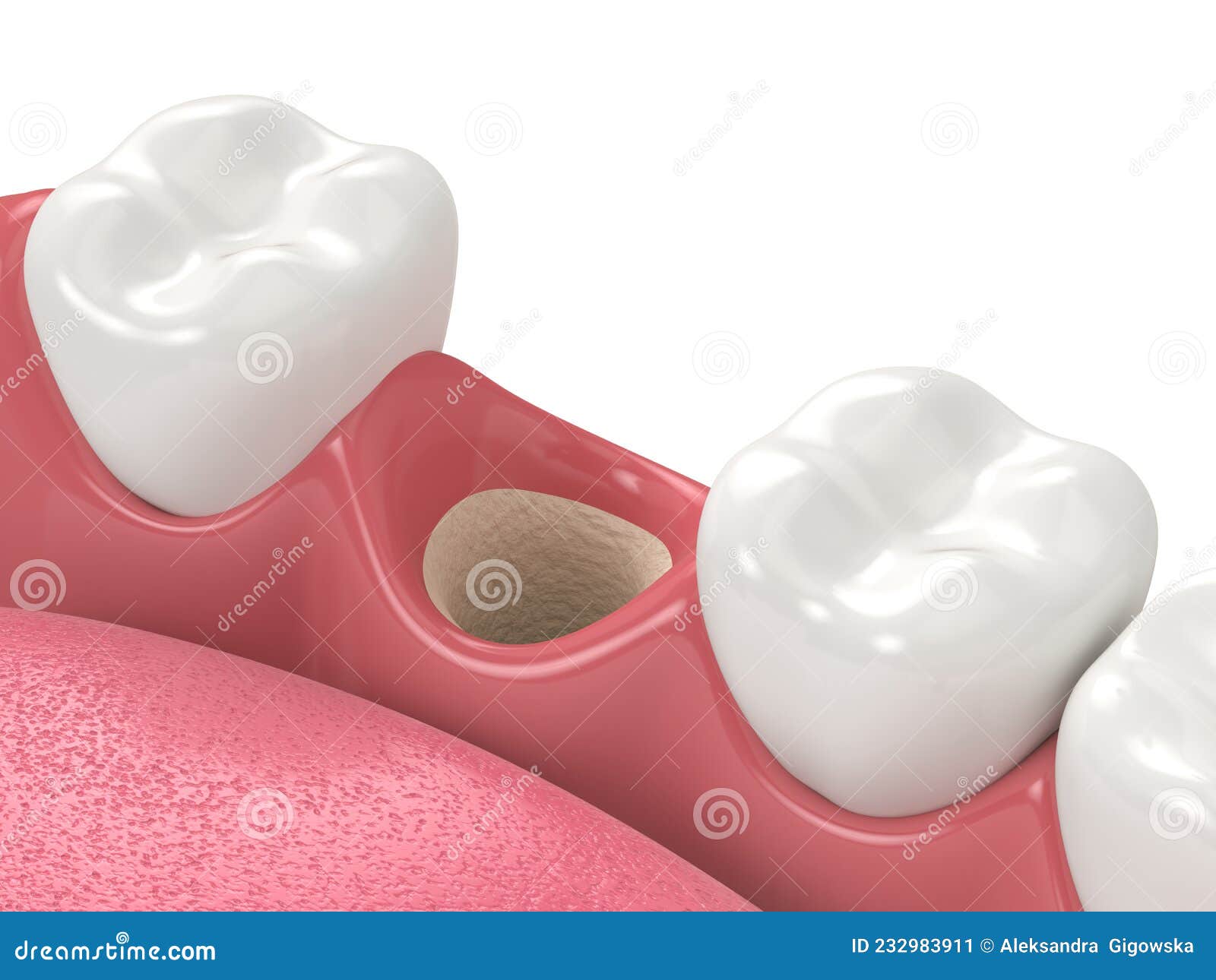 Bone Grafting- Augmentation Using Block Of Bone, Tooth Implantation ...