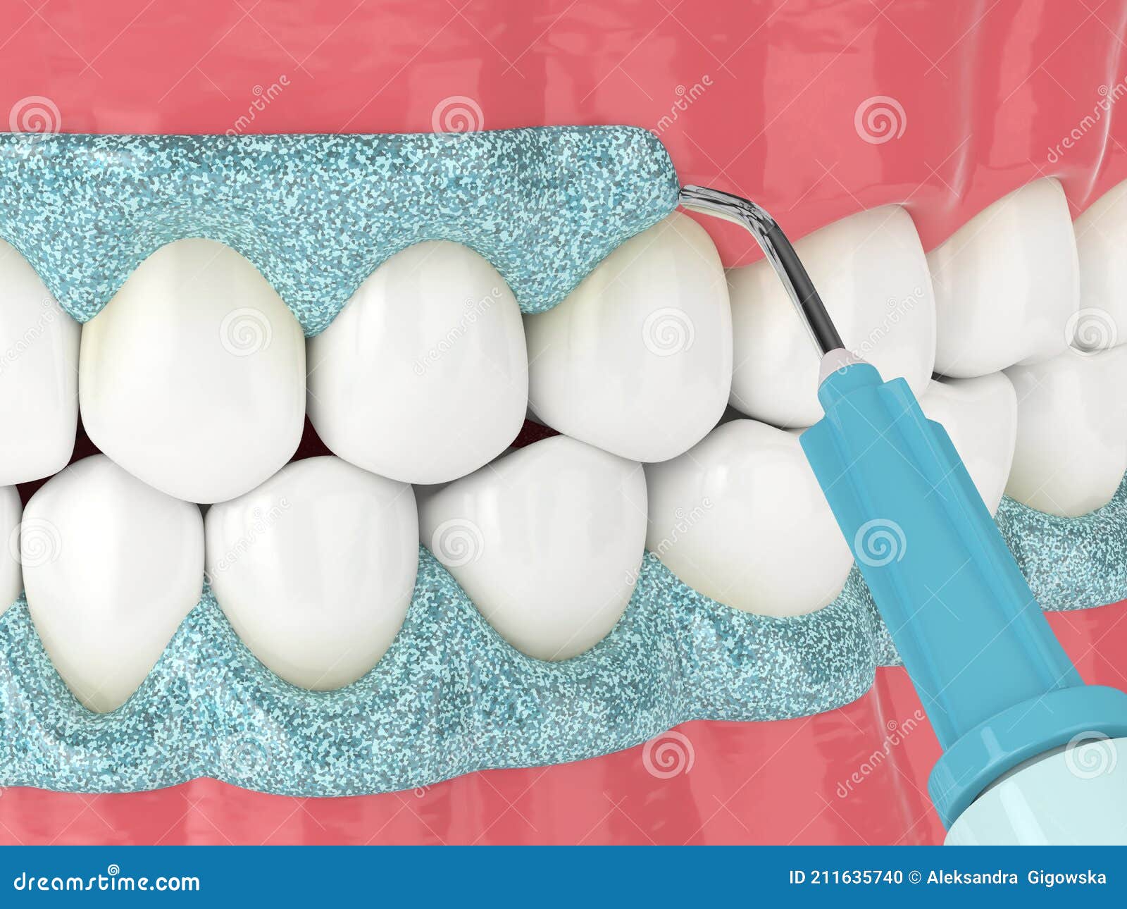 Gingival Cartoons, Illustrations & Vector Stock Images - 271 Pictures ...