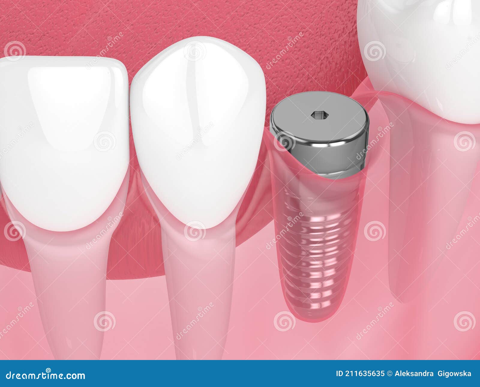 3d Render Of Jaw With Implant And Healing Cap Stock Illustration Illustration Of Placement