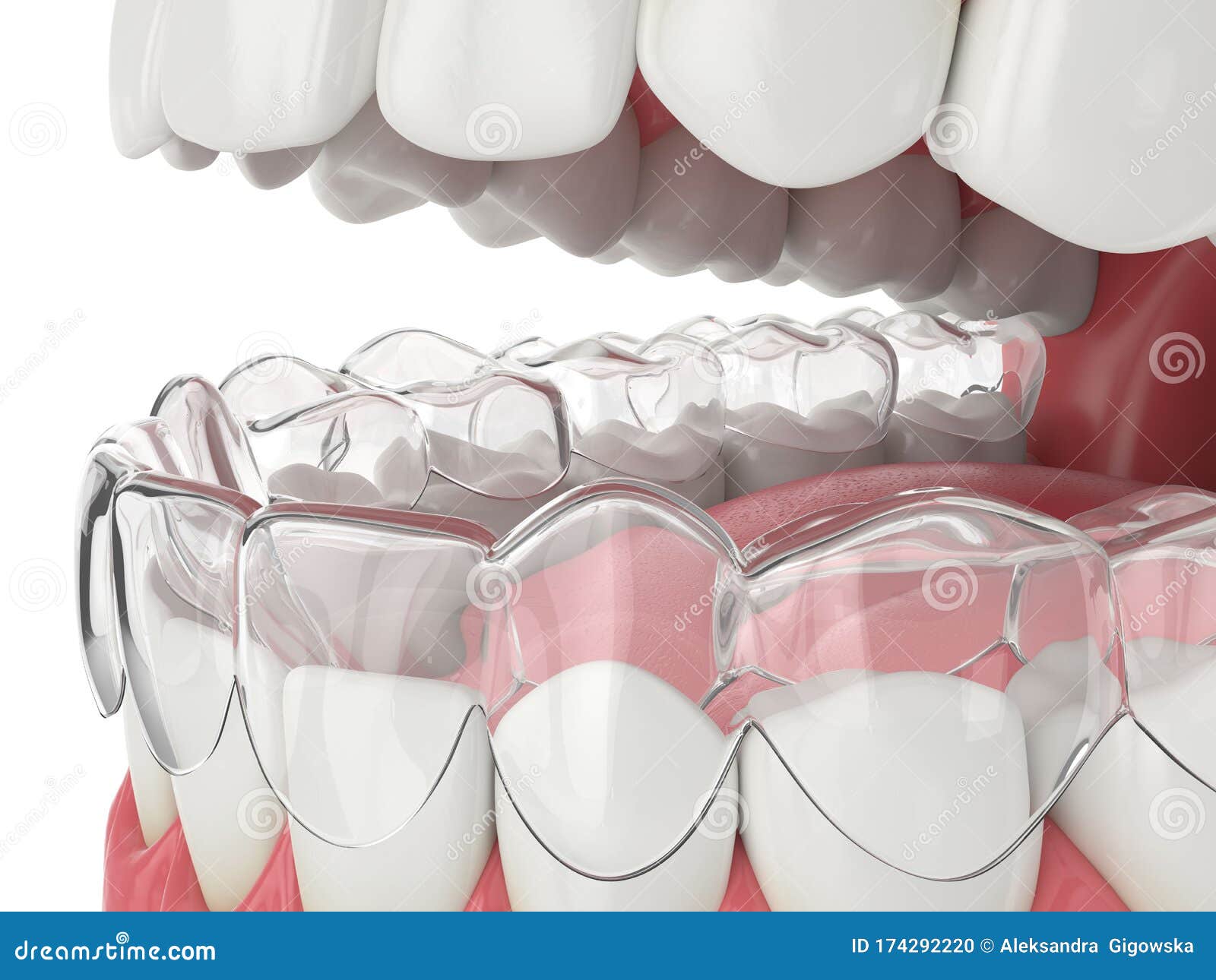 Invisalign Cartoons, Illustrations & Vector Stock Images - 511 Pictures ...