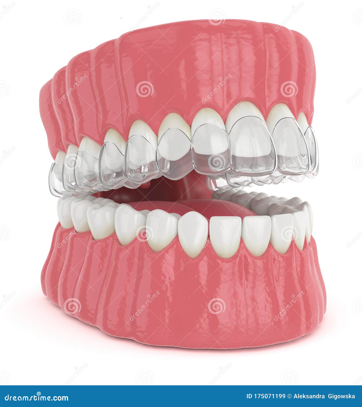 3d Render of Jaw with Invisalign Removable Retainer Stock Illustration ...