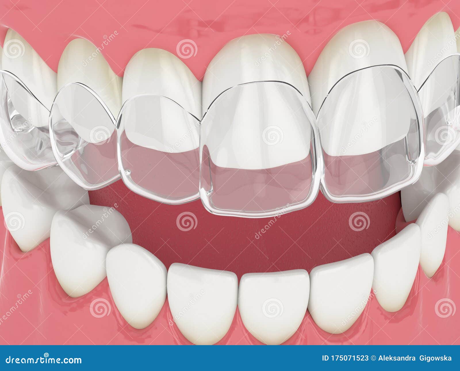 3d Render of Jaw with Invisalign Removable Retainer Stock Illustration ...