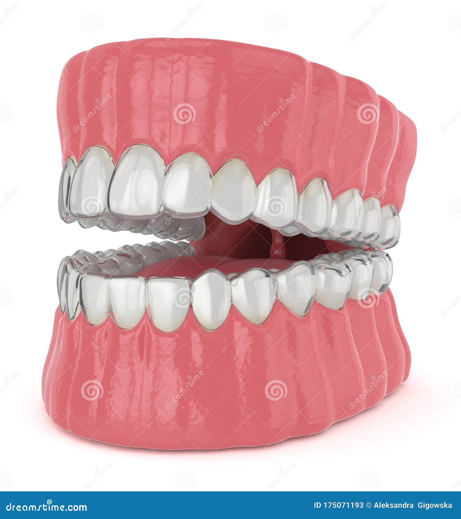 3d Render of Jaw with Invisalign Removable Retainers Stock Illustration ...
