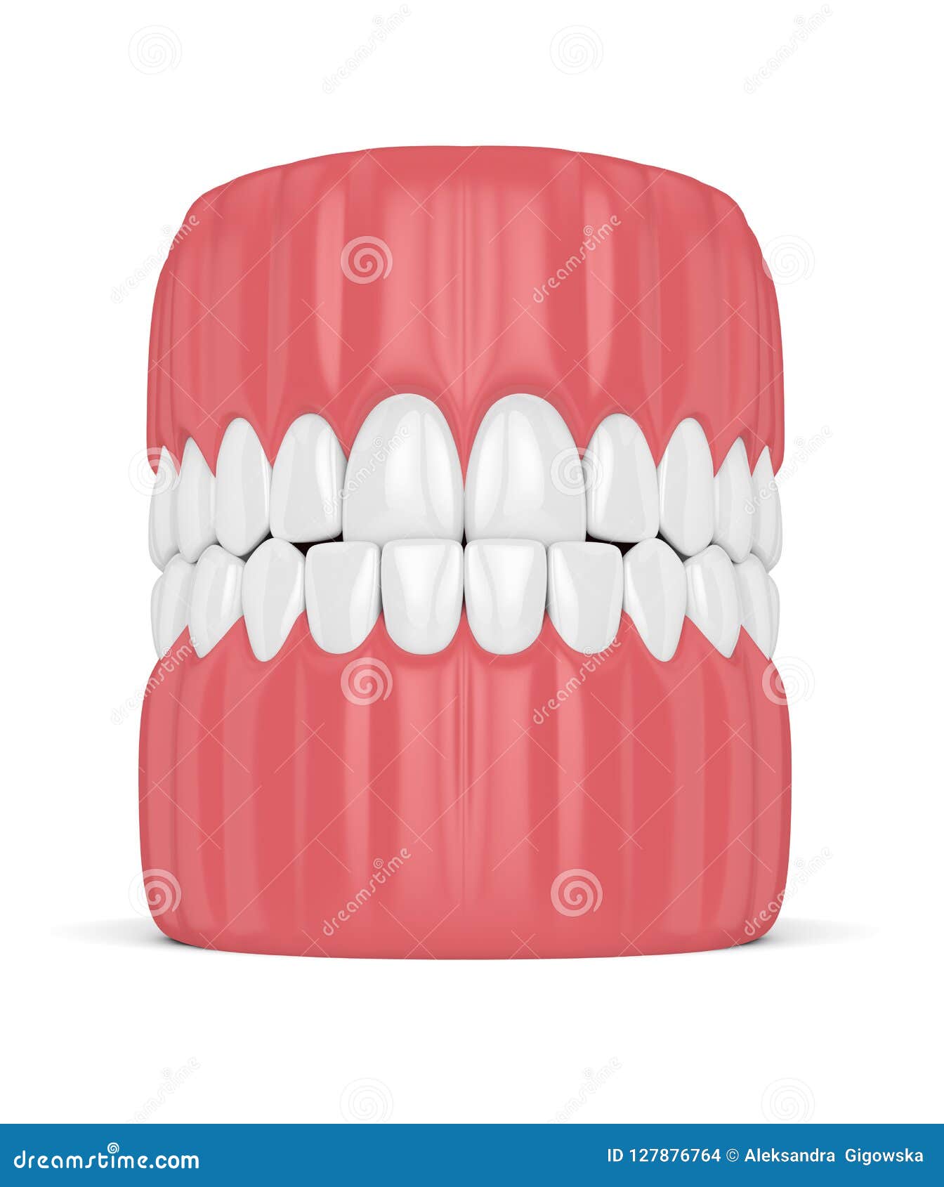3d Render Of Jaw Malocclusion With Underbite Royalty-Free Stock ...