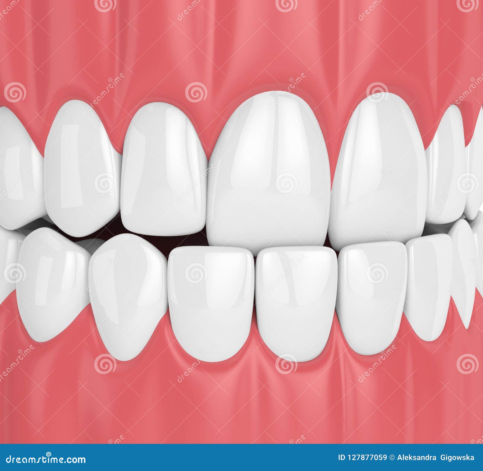 Underbite Dental Occlusion Malocclusion Of Teeth . Medically Accurate ...