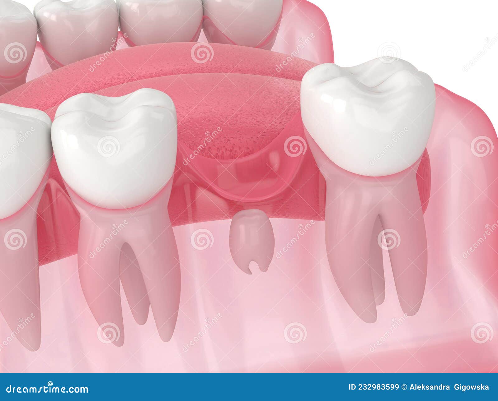 3d Render of Jaw with New Tooth Growing between Two Teeth Stock ...