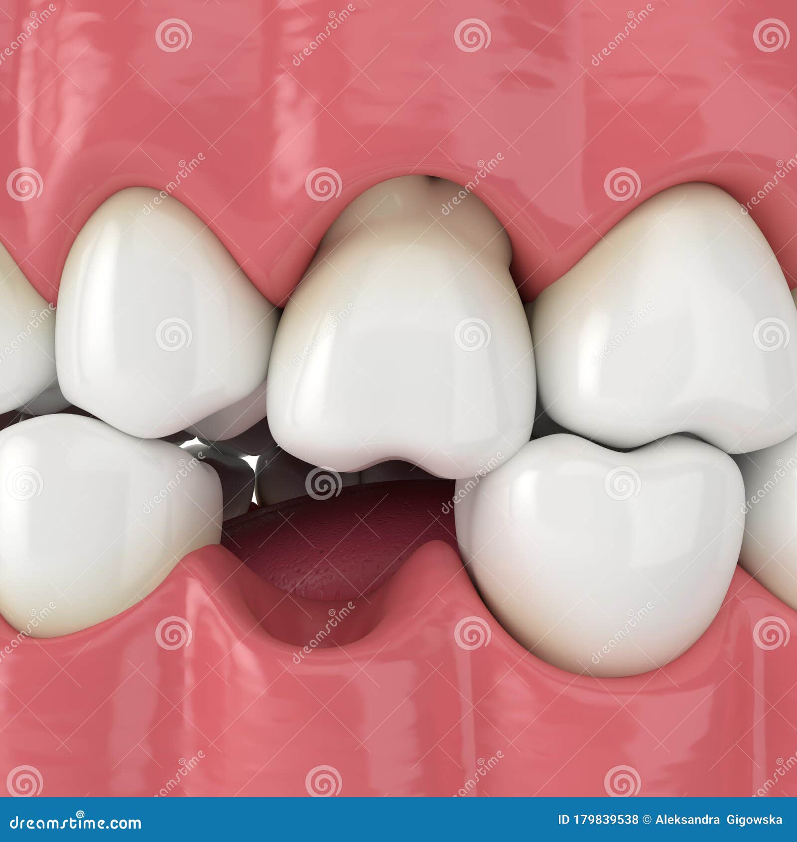 3d Render Of Jaw With Protruding Tooth Revealing Root Stock Photography ...