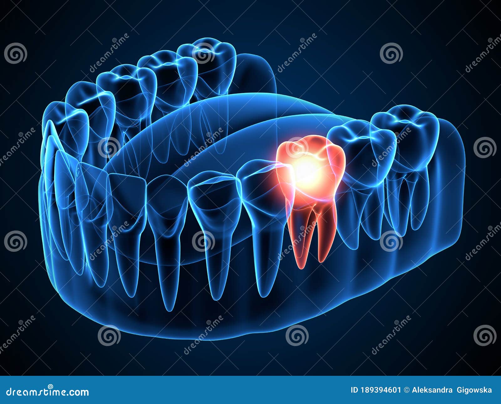 3d Render of Jaw X-ray with Aching Tooth Stock Illustration ...