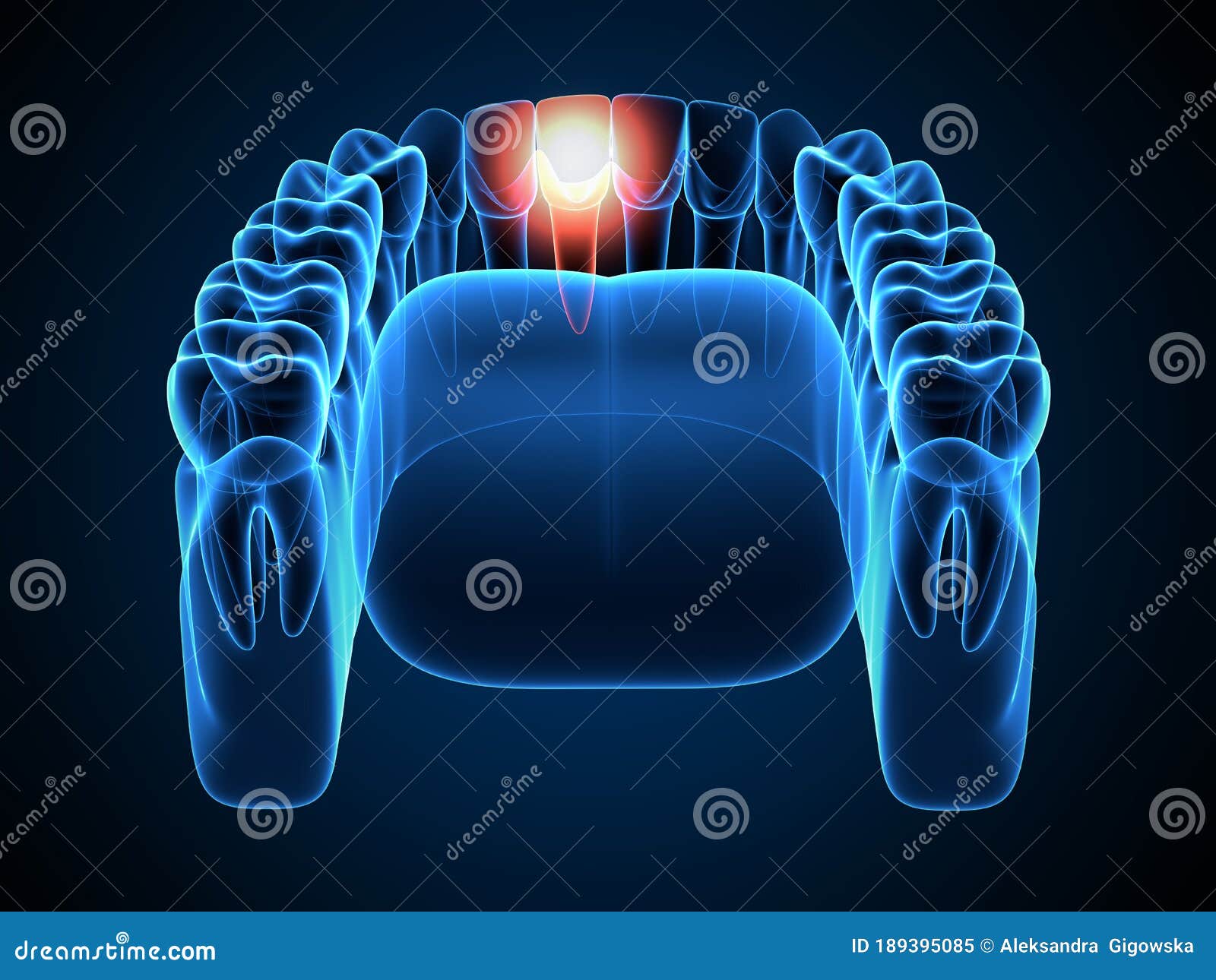3d Render of Jaw X-ray with Aching Tooth Stock Illustration ...