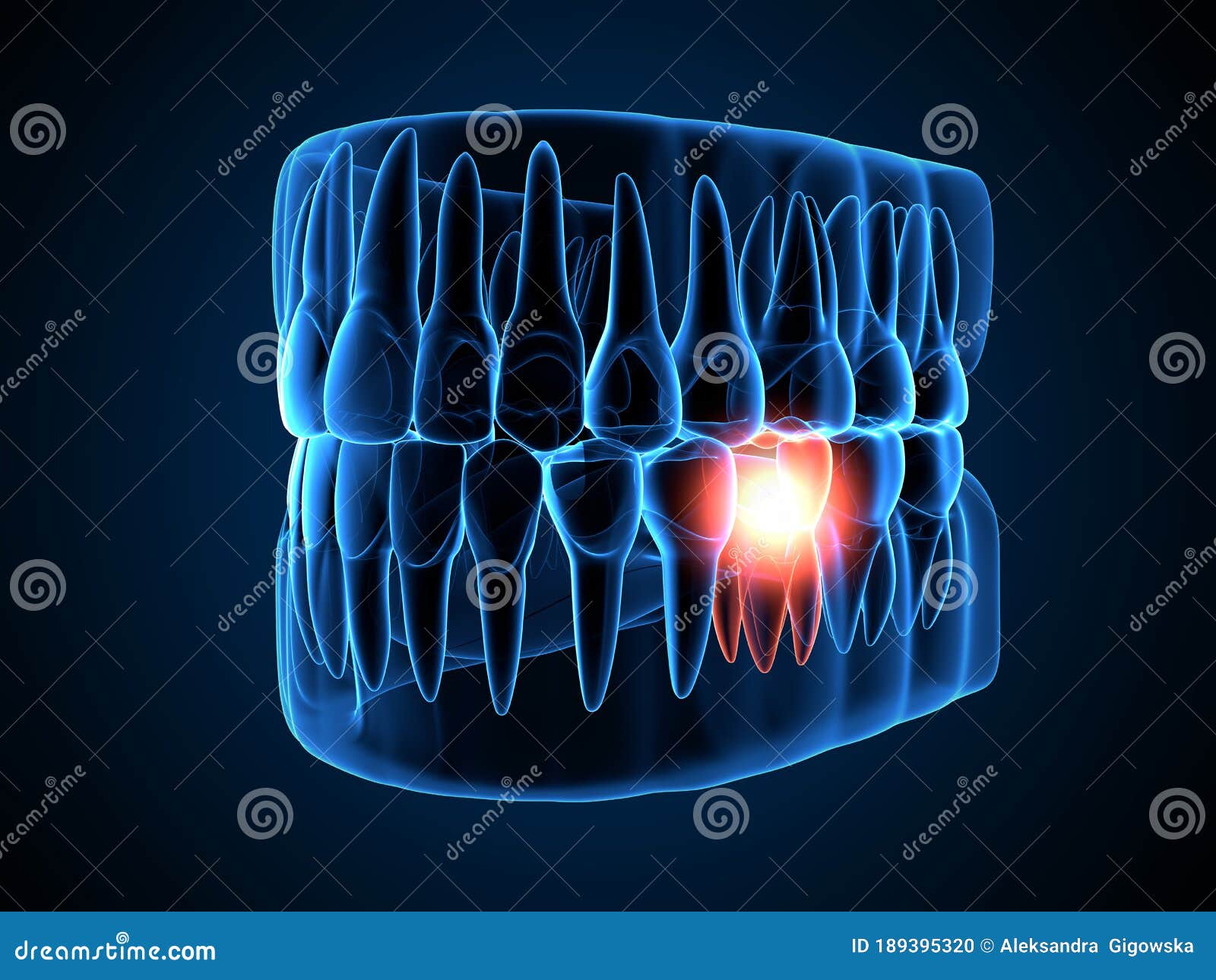 3d Render of Jaw X-ray with Aching Tooth Stock Illustration ...