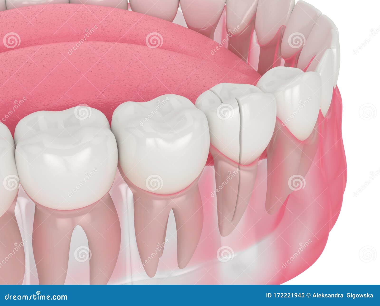 3d Render of Jaw with Split Tooth Stock Illustration - Illustration of ...