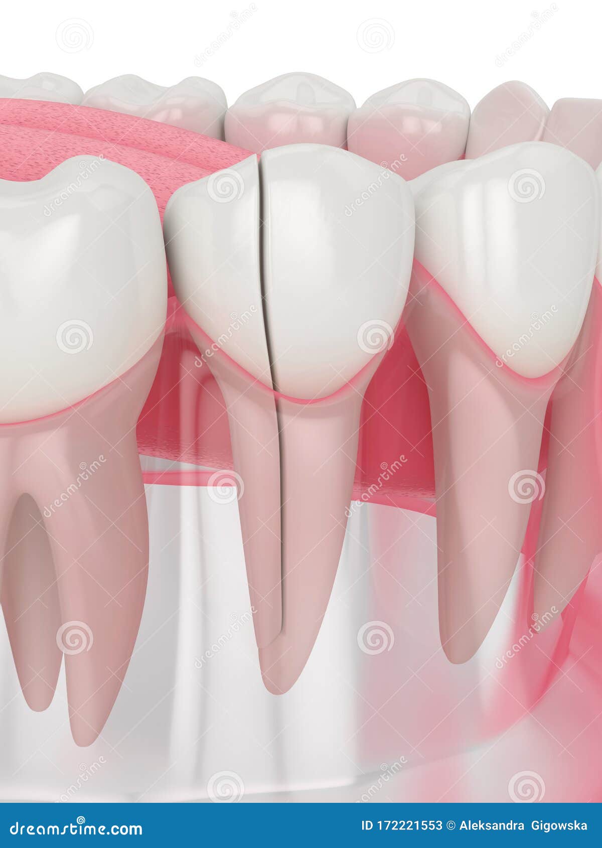 3d Render Of Jaw With Split Tooth Royalty-Free Stock Photography ...