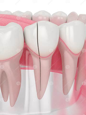 3d Render of Jaw with Split Tooth Stock Illustration - Illustration of ...