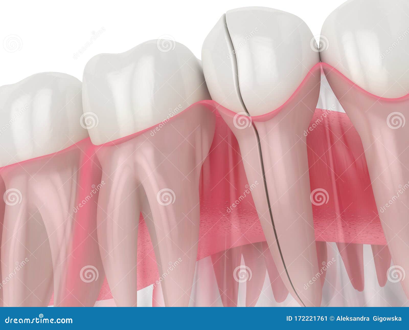 3d Render Of Jaw With Split Tooth Royalty-Free Stock Photography ...
