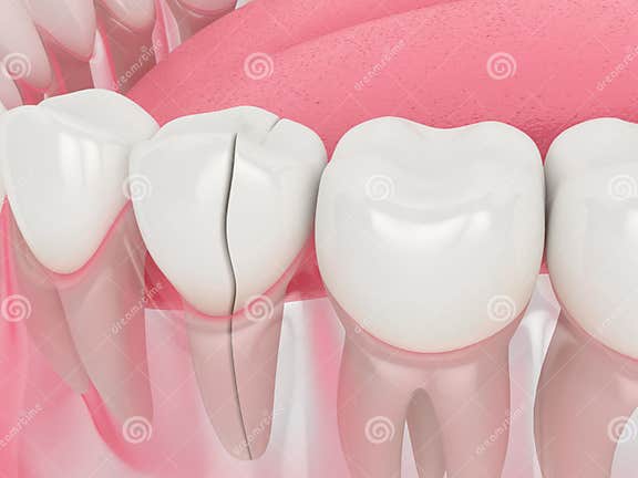 3d Render of Jaw with Split Tooth Stock Illustration - Illustration of ...
