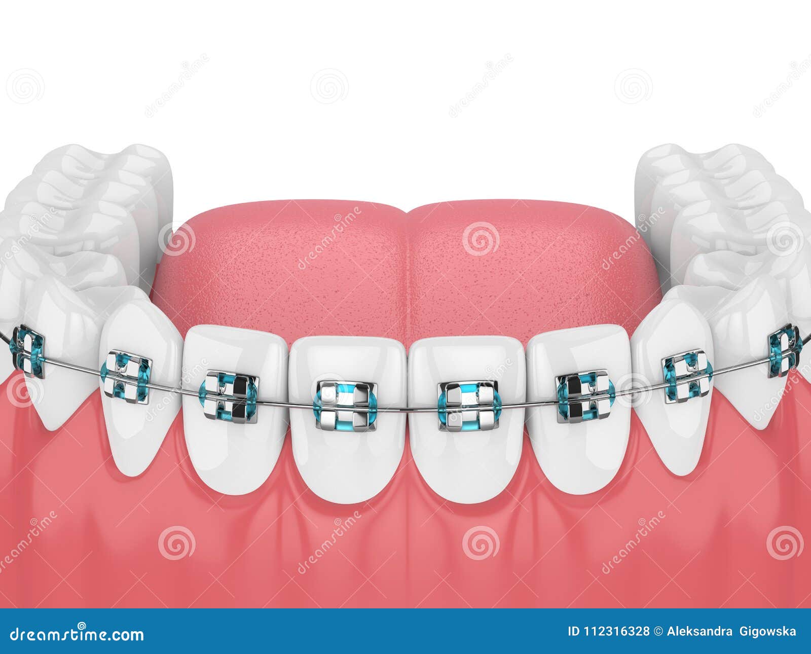 Orthodontic Braces Banner With Teeth Characters Cartoon Vector ...