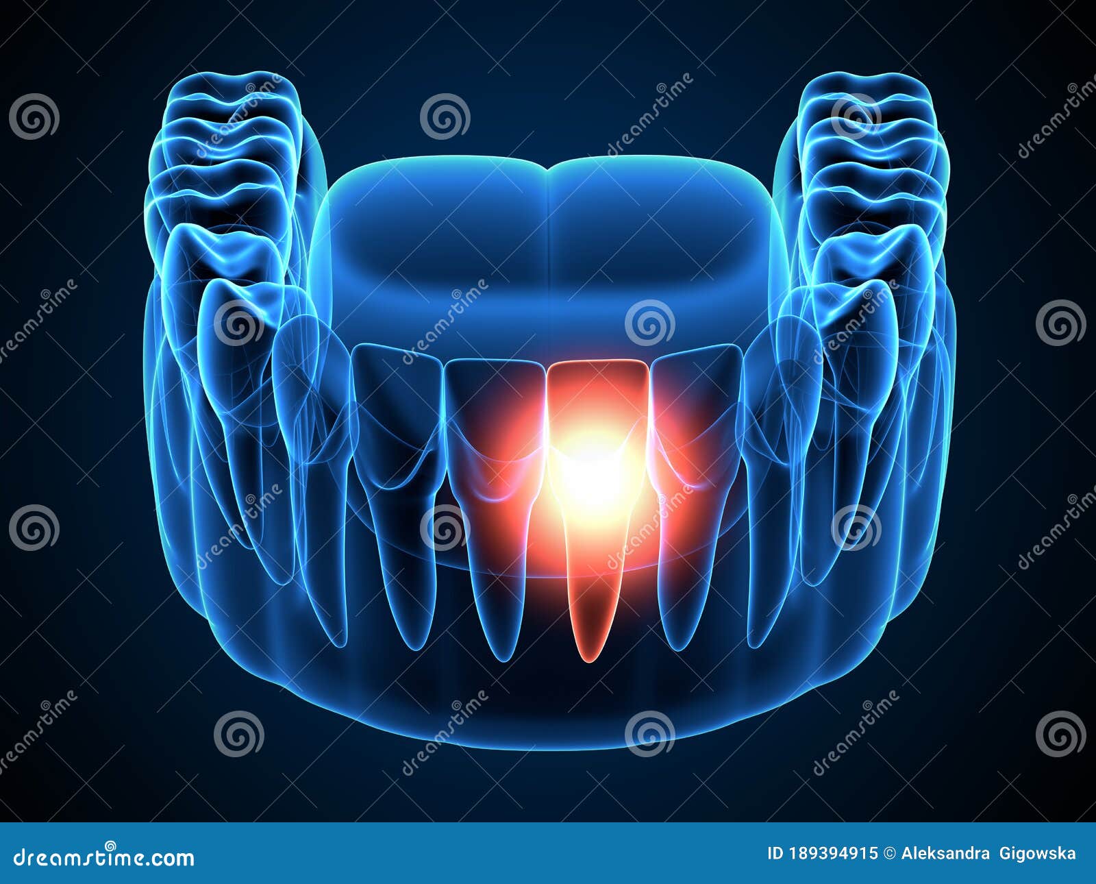 3d Render Of Jaw X-ray With Throbbing Toothache Royalty-Free Stock ...
