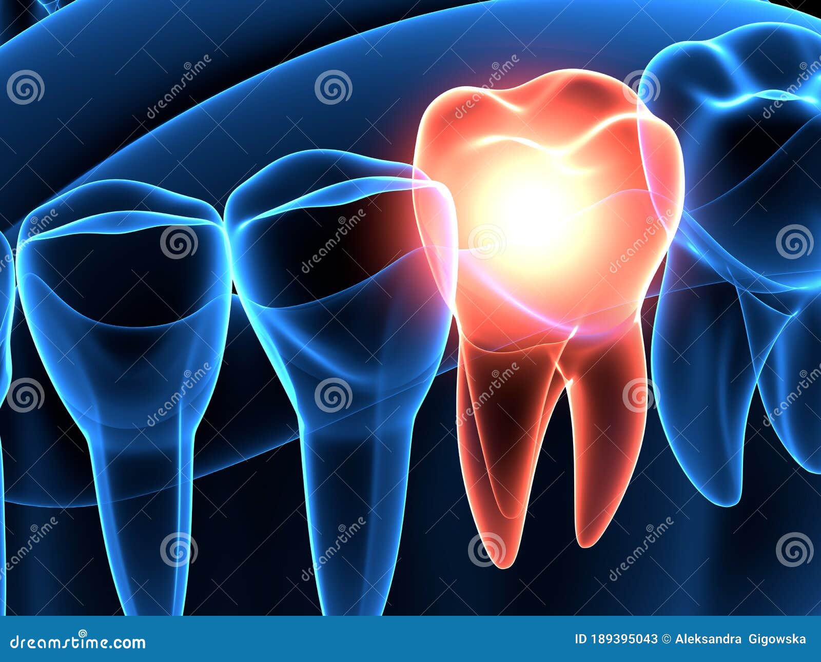 3d Render Of Jaw X-ray With Throbbing Toothache Royalty-Free Stock ...