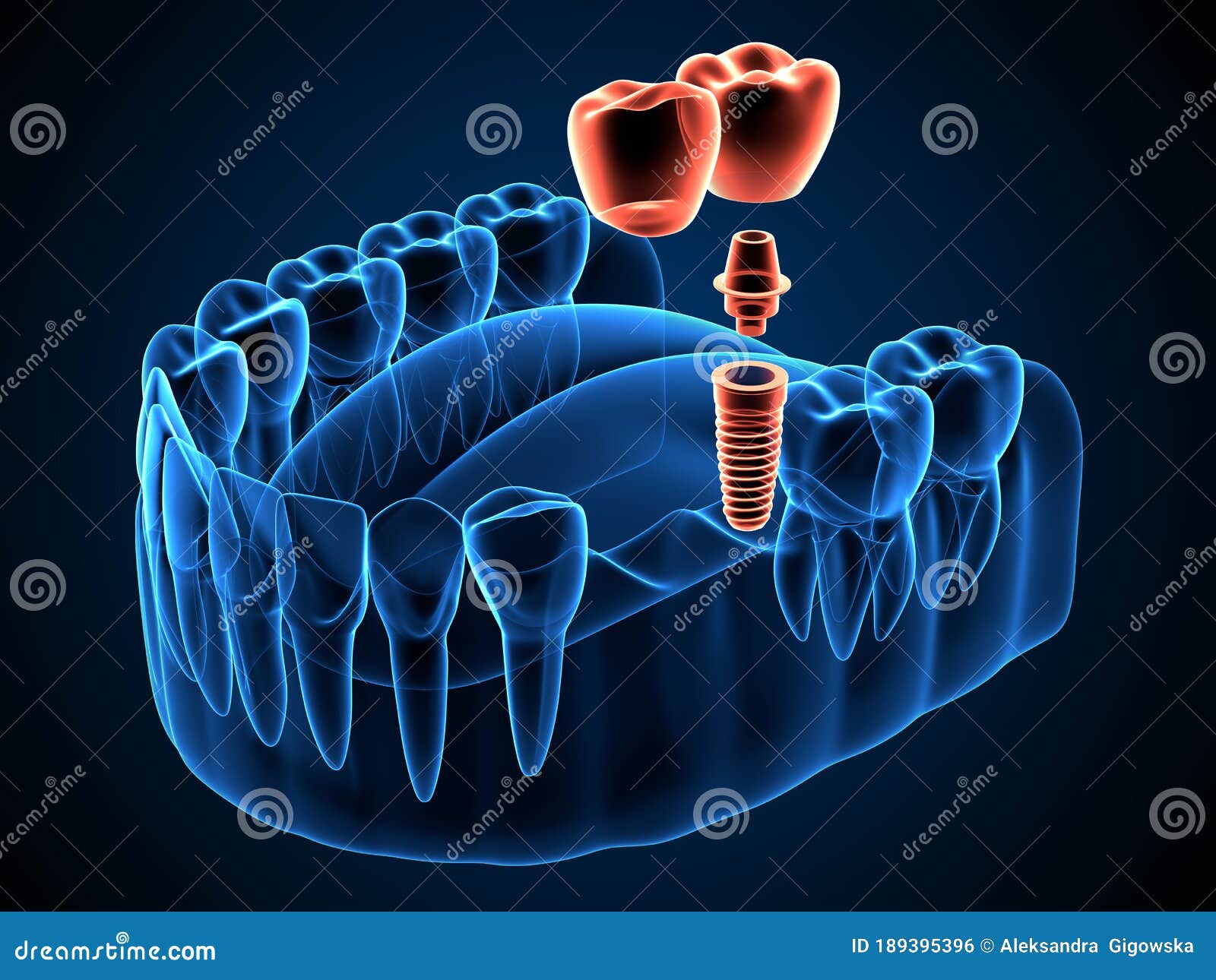 Cantilever Bridge Implant Based, Frontal Tooth Recovery. Medically ...