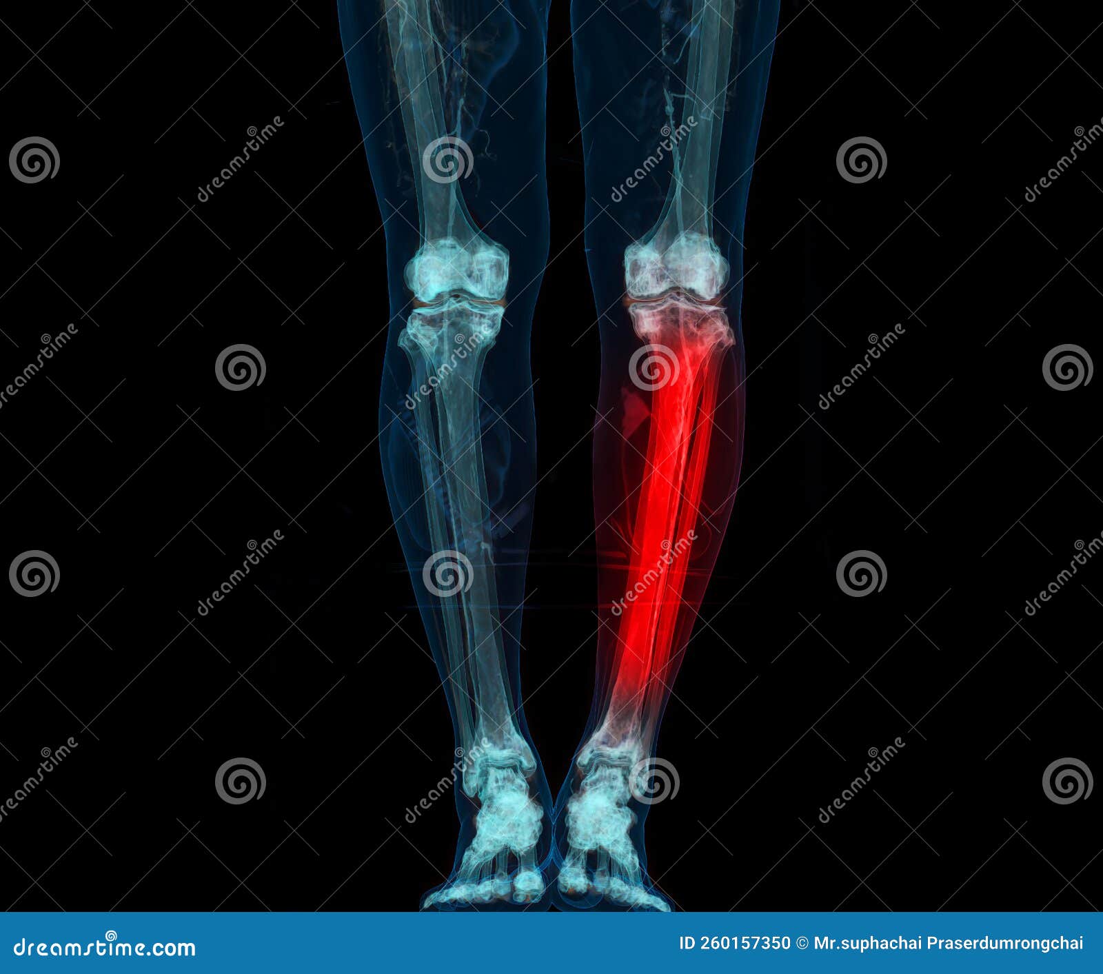 3D Render of Lower Extremity or Legs Isolated on Black Background Stock ...