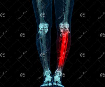 3D Render of Lower Extremity or Legs Isolated on Black Background Stock ...