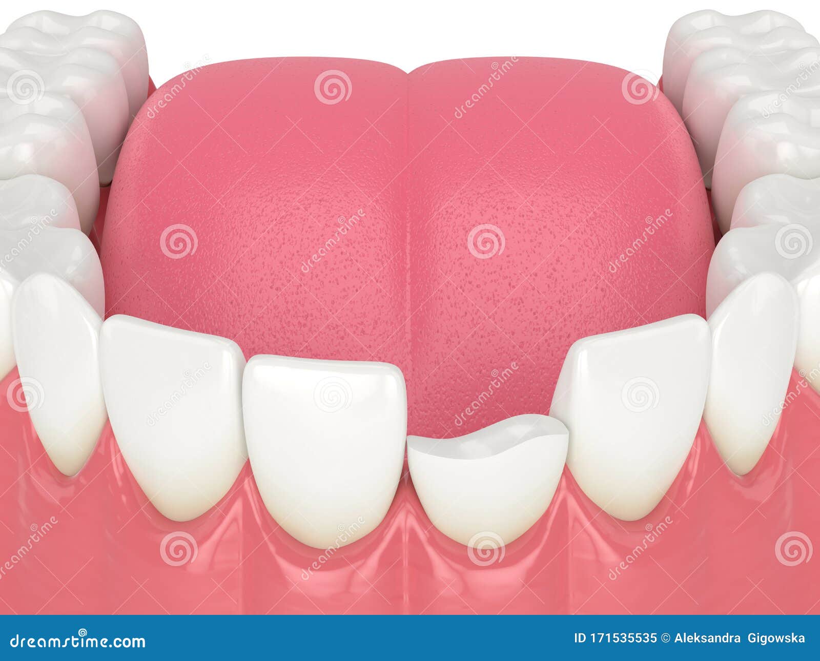 3d Render of Lower Jaw with Broken Incisor Tooth Stock Illustration ...