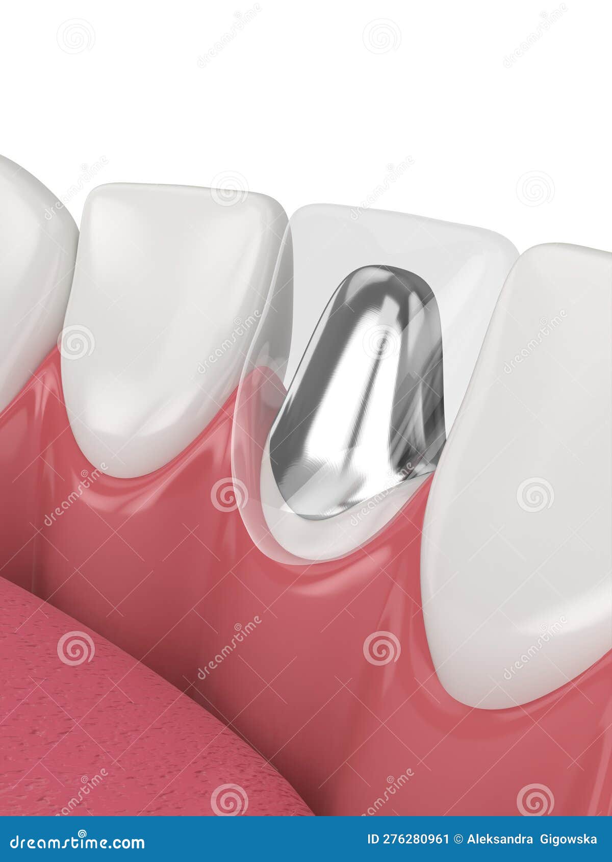 3d Render of Lower Jaw with Cast Post and Core Tooth Restoration Stock ...