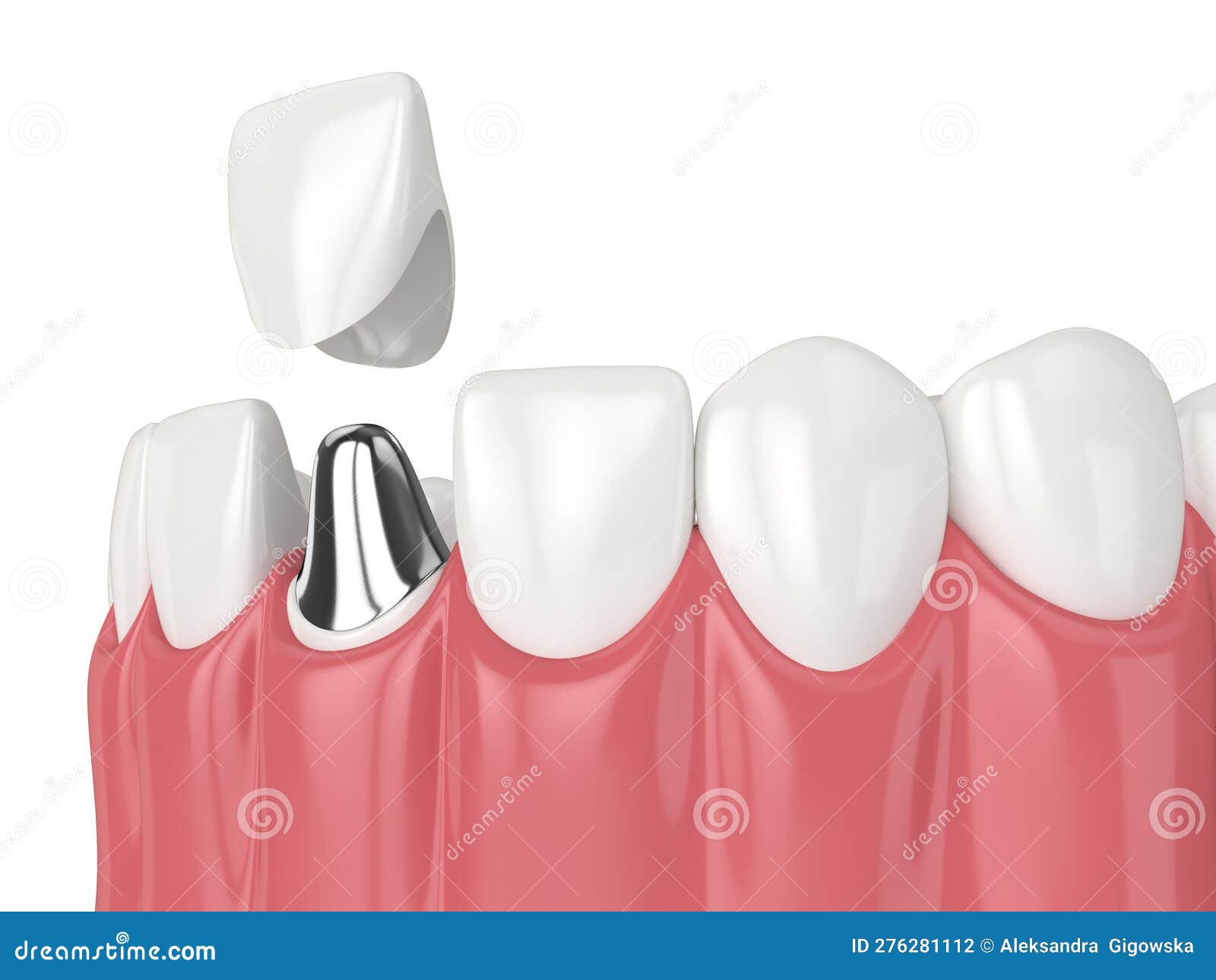 3d Render of Lower Jaw with Cast Post and Core Tooth Restoration Stock ...