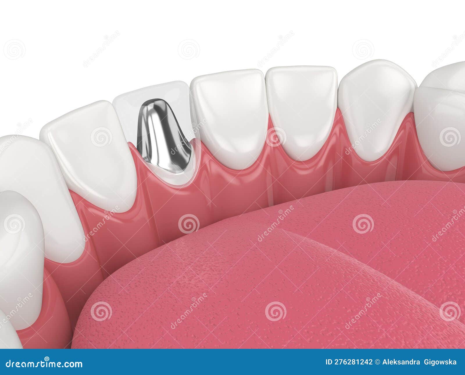3d Render of Lower Jaw with Cast Post and Core Tooth Restoration Stock ...
